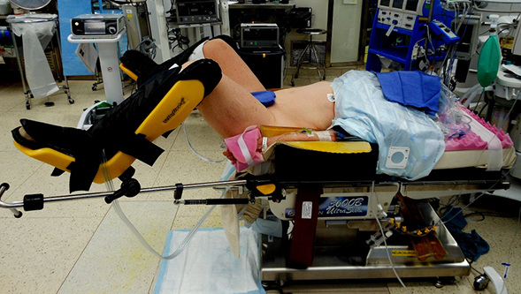 Laparoscopically Assisted Vaginal Hysterectomy Lavh Stepwards