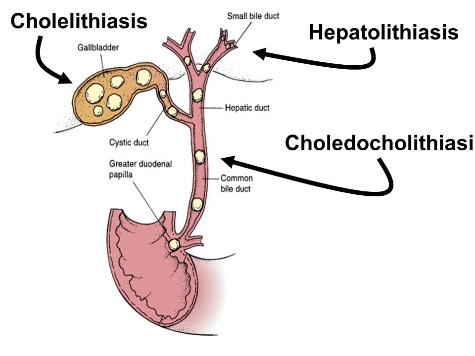 Choledocholithiasis Stepwards Choledocholithiasis Stepwards