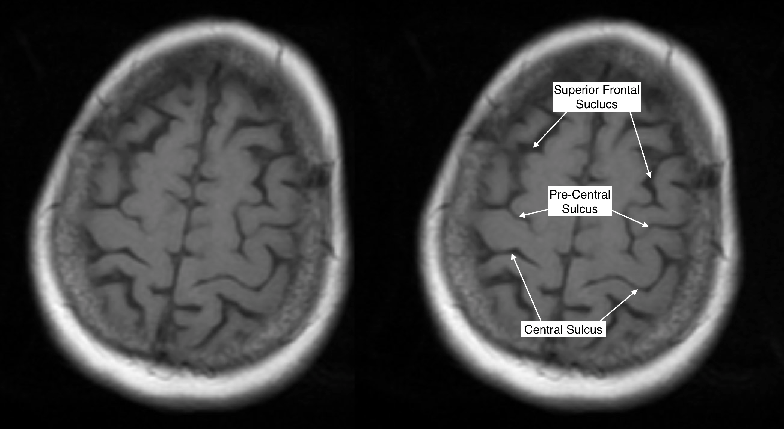 Radiological Anatomy Central Sulcus Stepwards