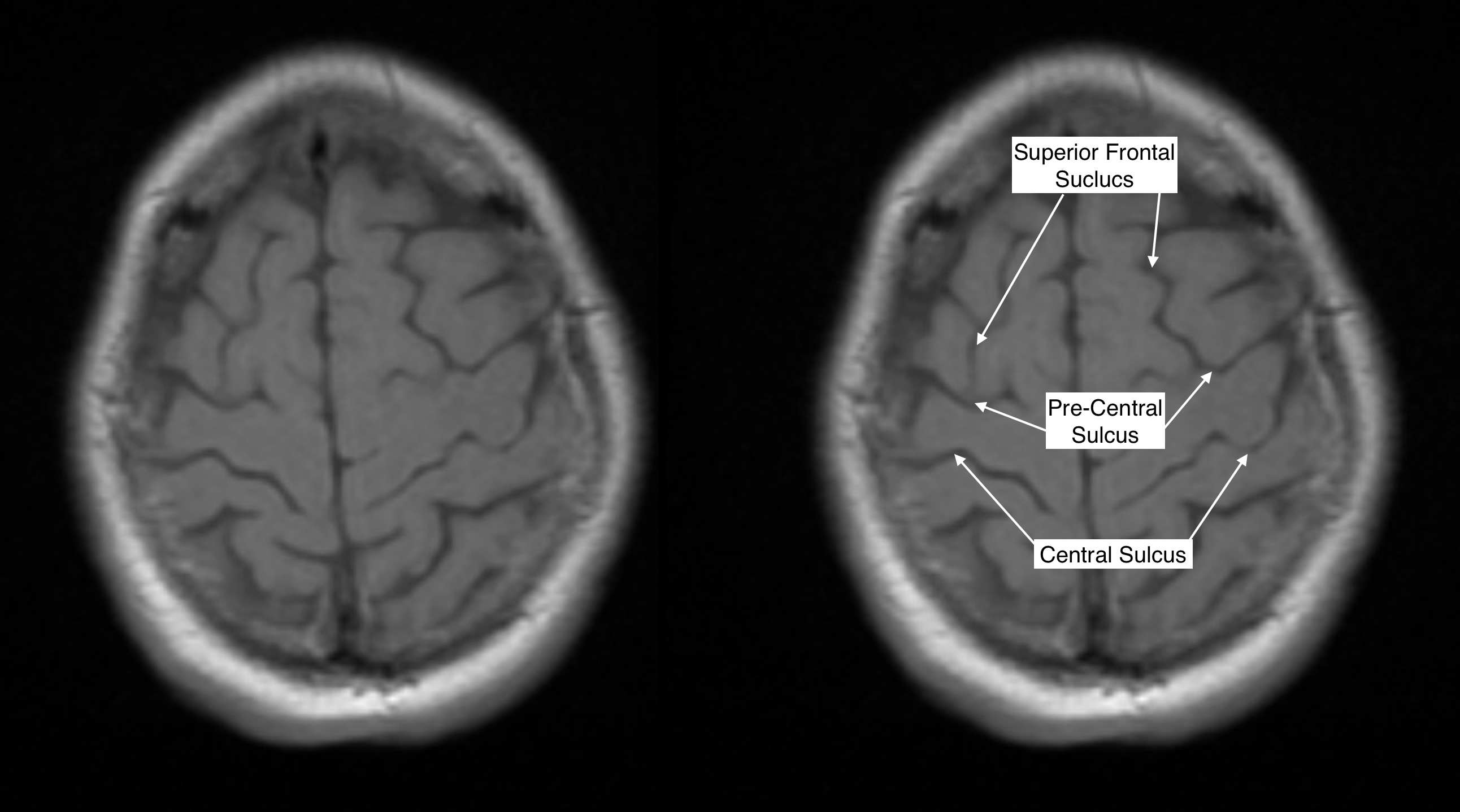 Intraparietal Sulcus Mri Intraparietal Sulcus Mri
