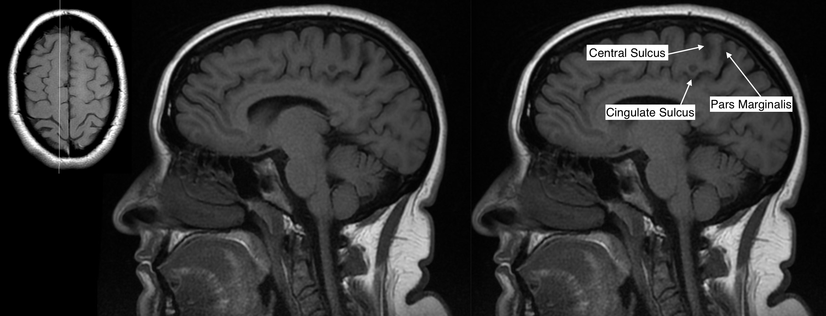 Radiological Anatomy Central Sulcus Stepwards
