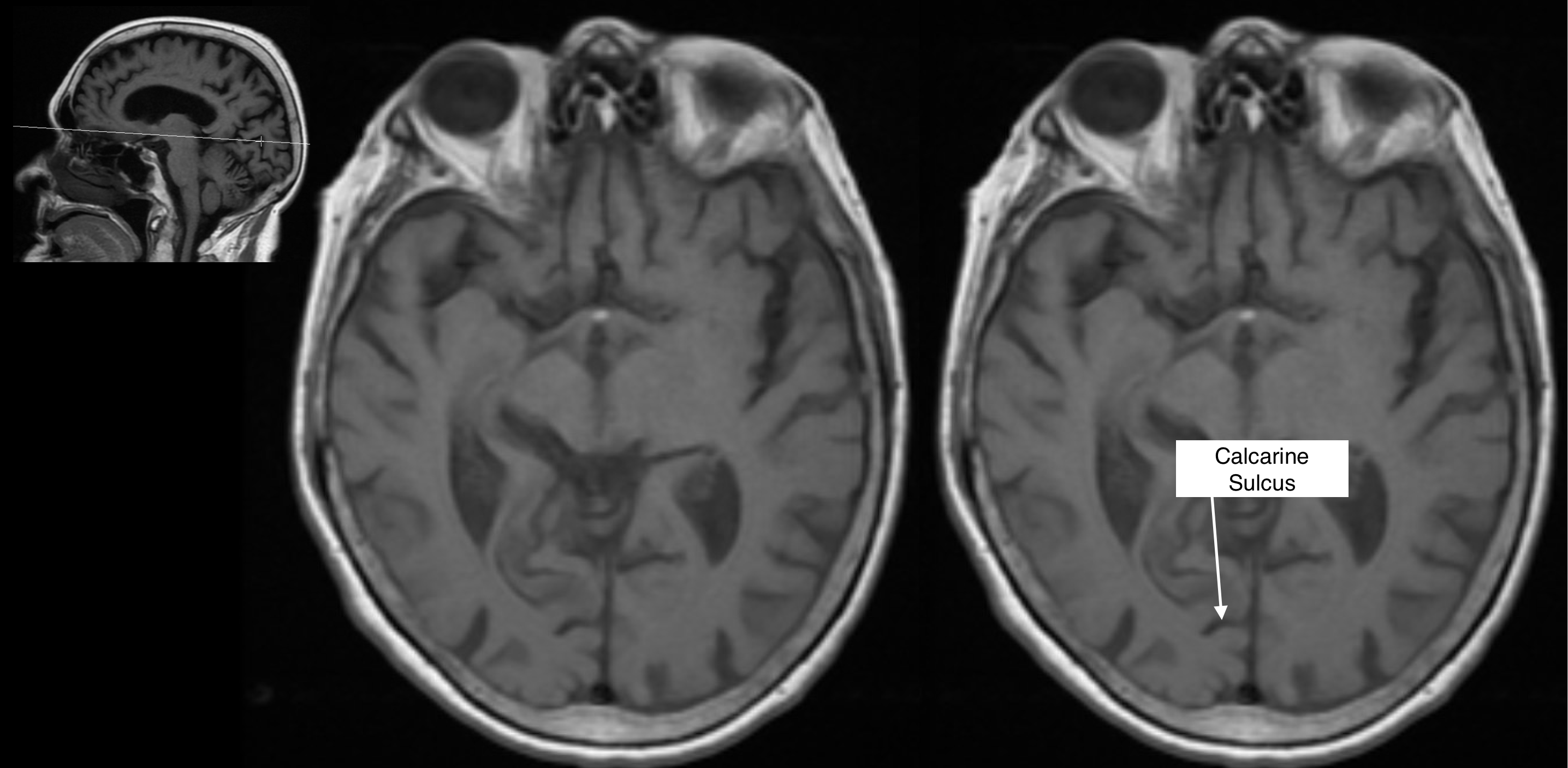 Radiological Anatomy Calcarine Sulcus Stepwards