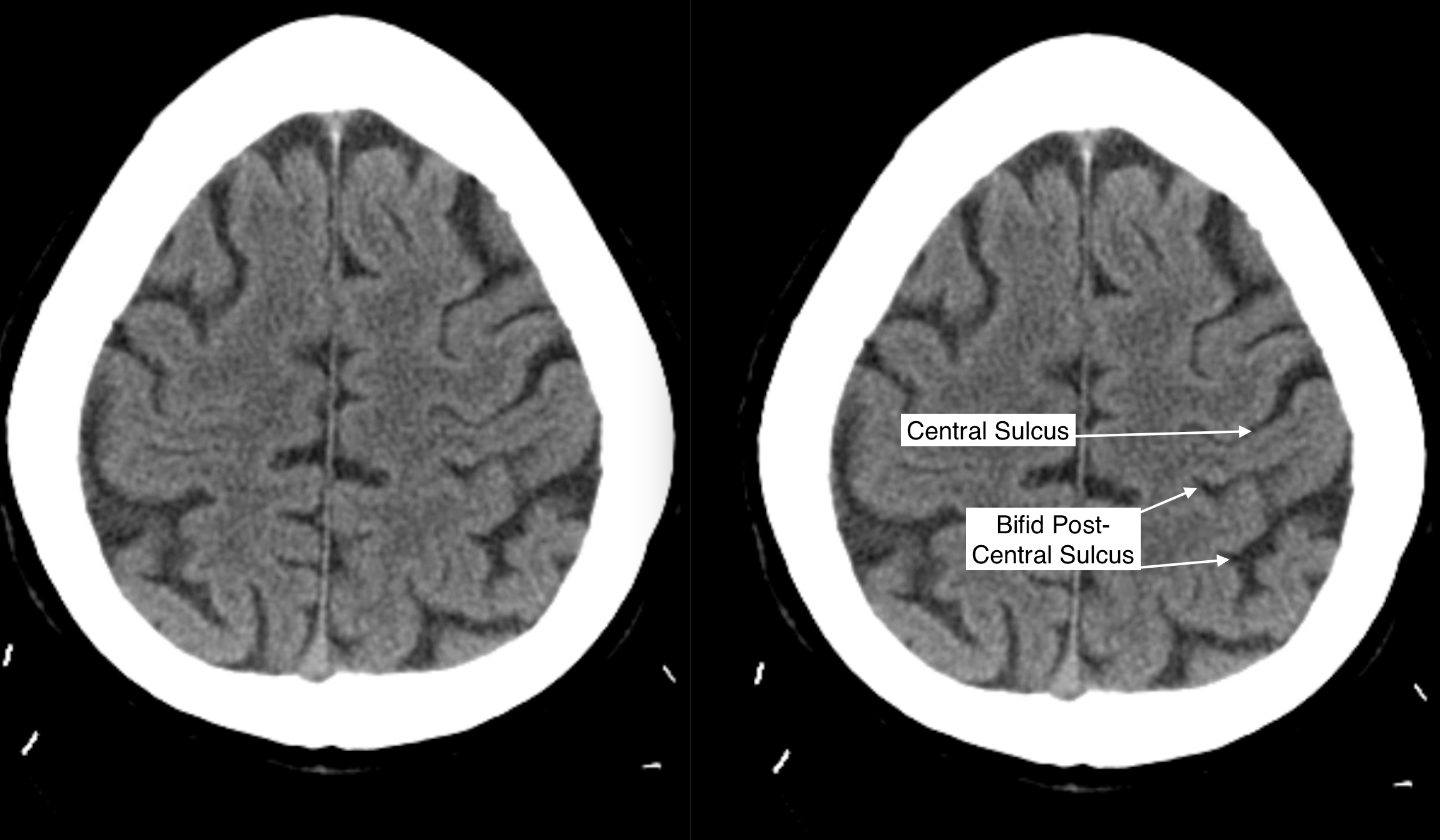Radiological Anatomy Central Sulcus Stepwards