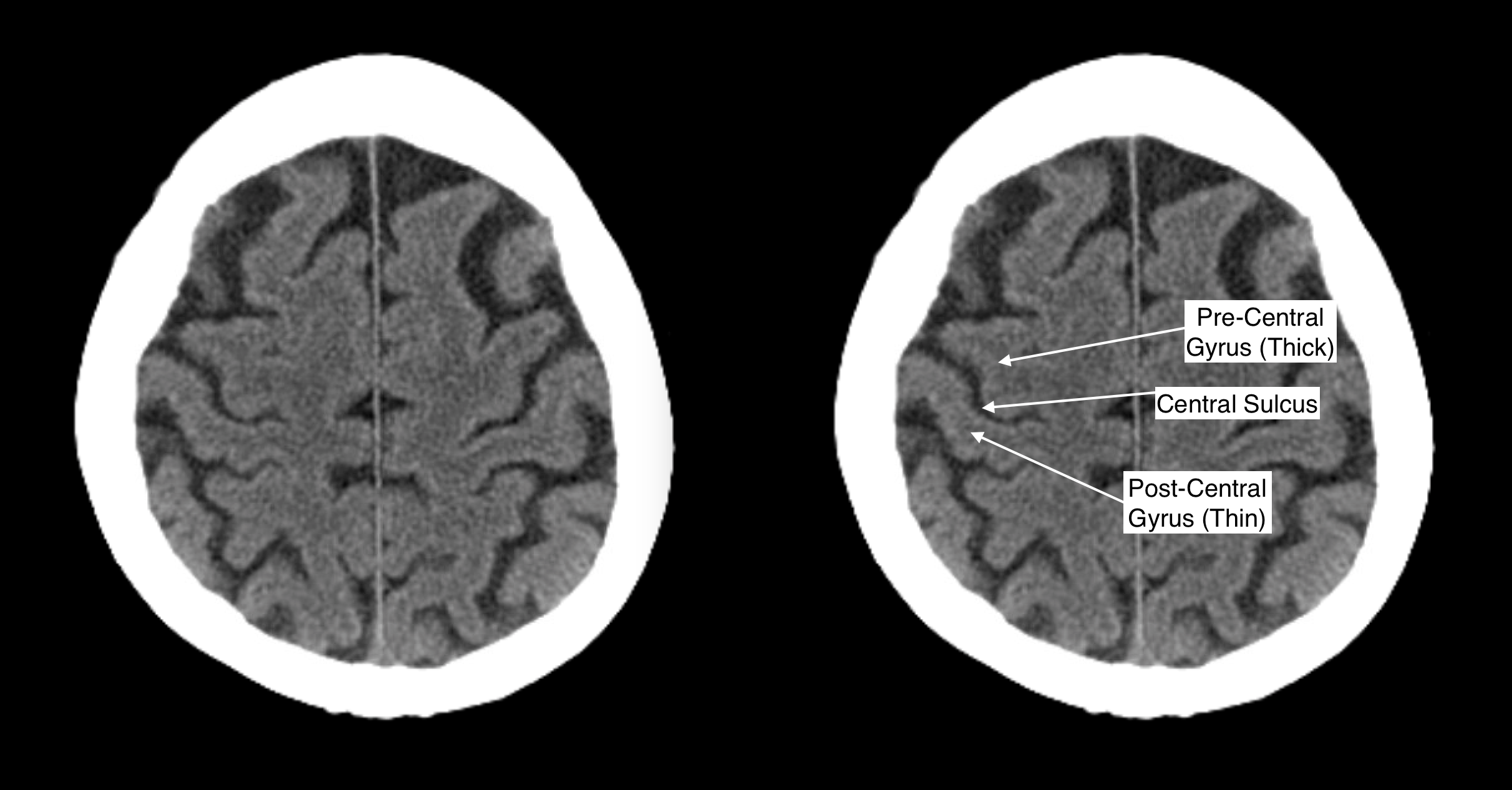 Radiological Anatomy Central Sulcus Stepwards