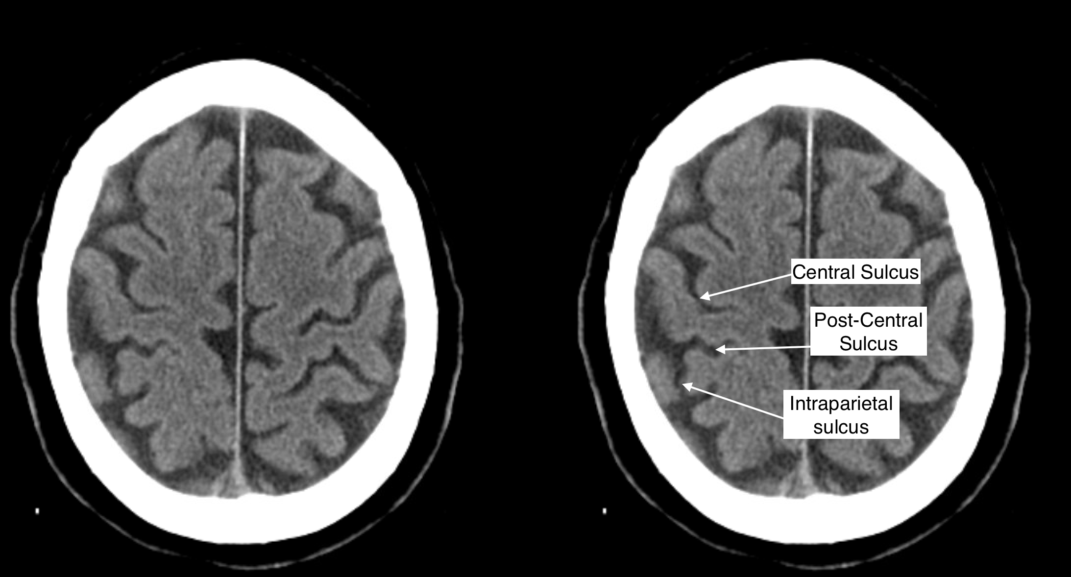 Radiological Anatomy Central Sulcus Stepwards
