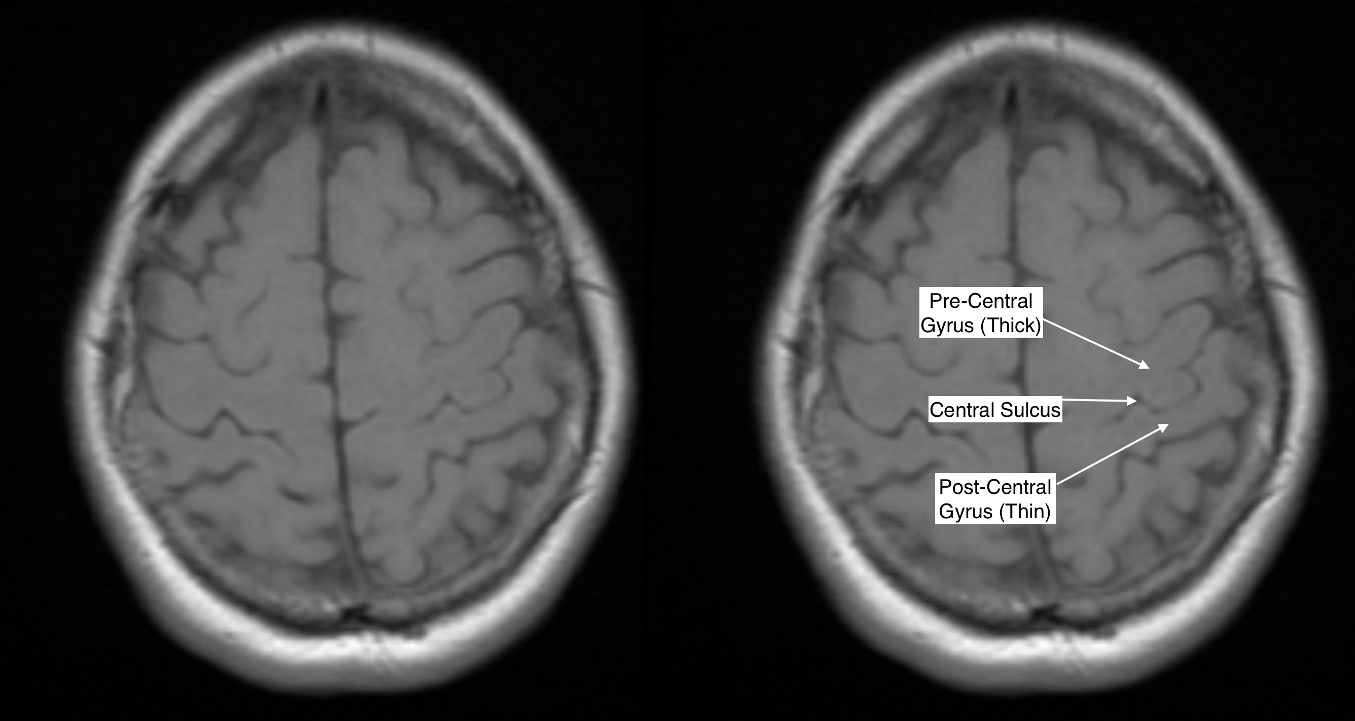 Radiological Anatomy Central Sulcus Stepwards