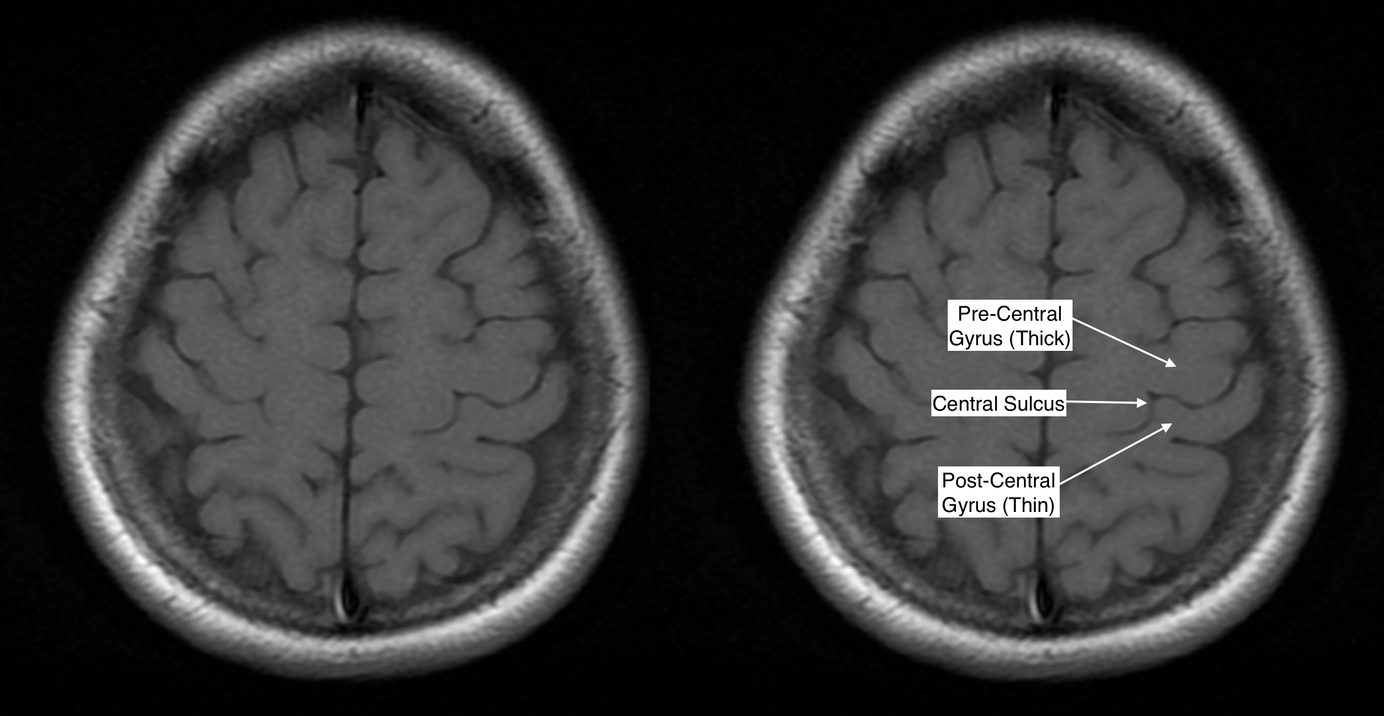 Radiological Anatomy Central Sulcus Stepwards