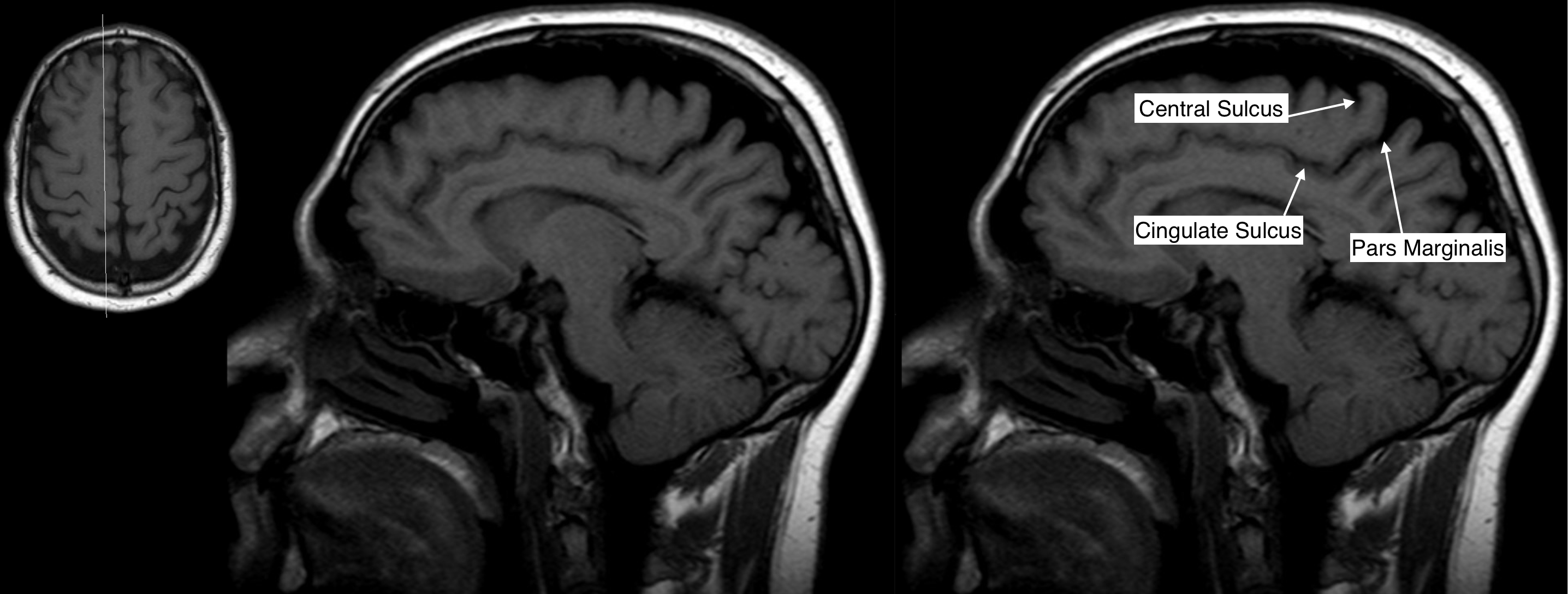 Radiological Anatomy Central Sulcus Stepwards
