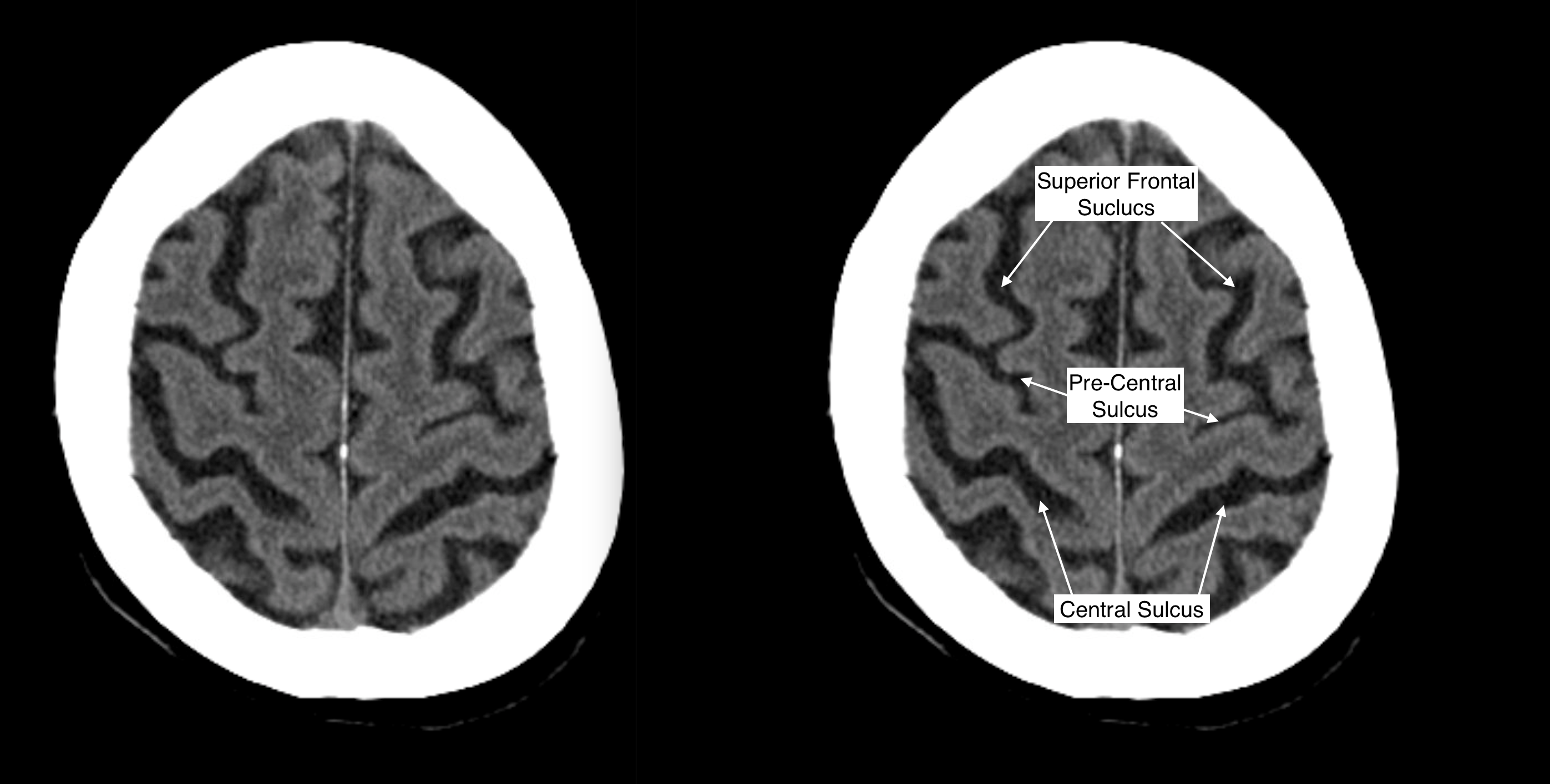 Radiological Anatomy Central Sulcus Stepwards