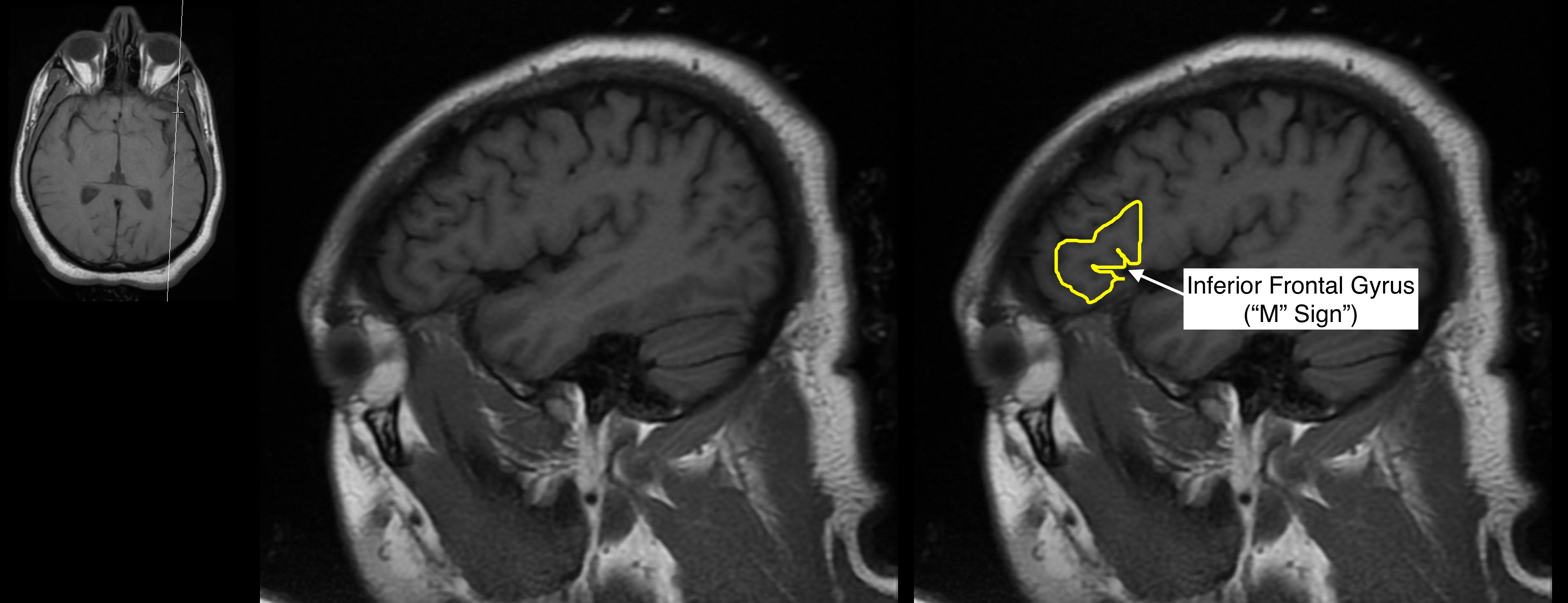 Superior Frontal Gyrus Mri