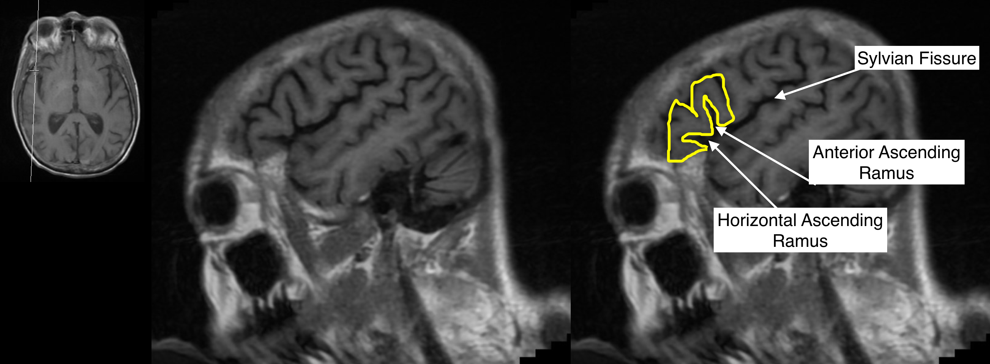 Superior Frontal Gyrus Mri