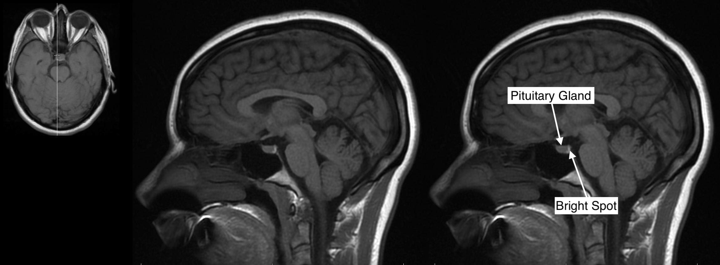 Radiological Anatomy Pituitary Gland Stepwards