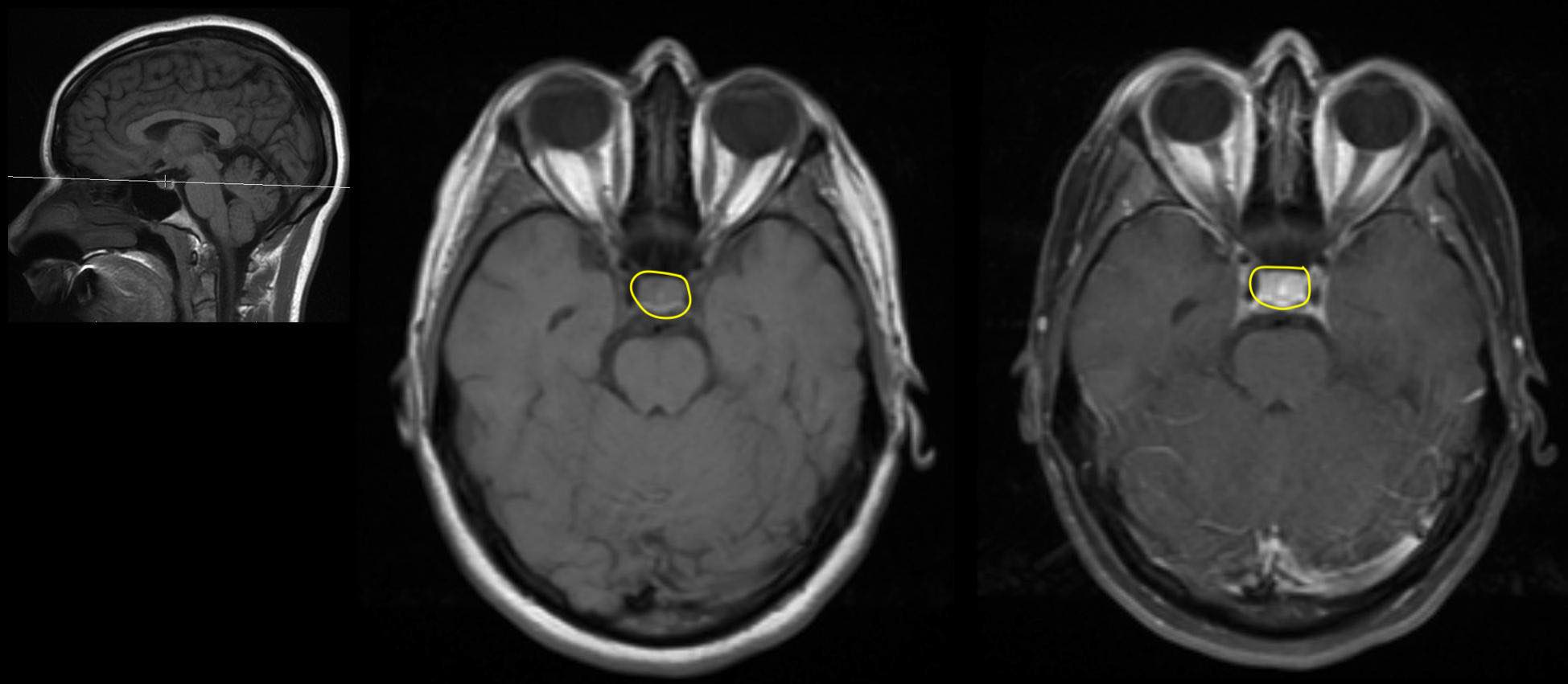 Pituitary Mri