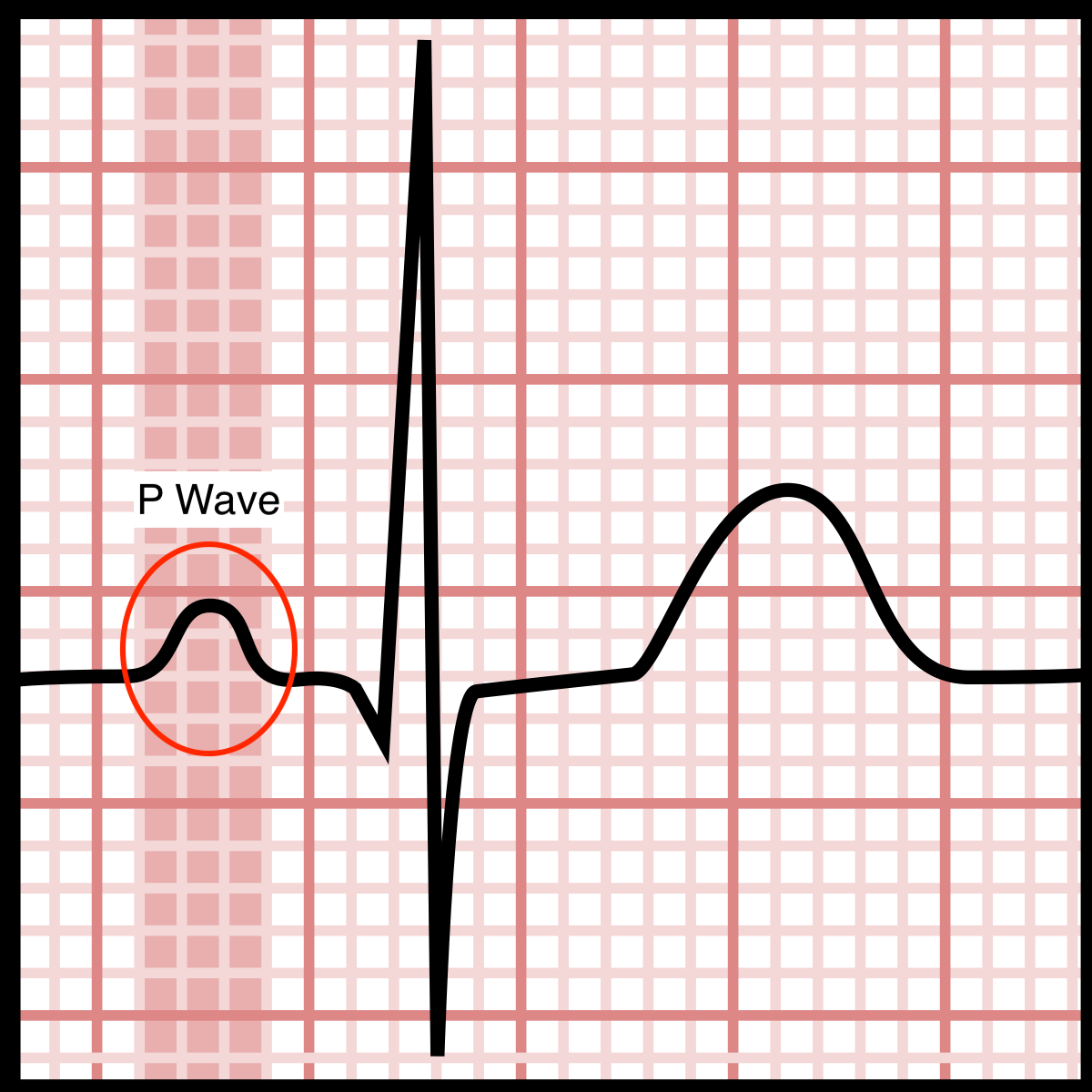 Electrocardiograms EKGs ECGs Evaluating P Waves Stepwards Electrocardiograms EKGs ECGs Evaluating P Waves Stepwards