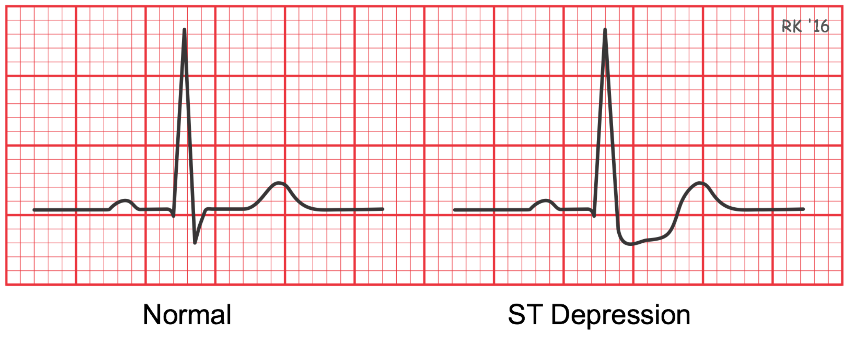 ST Depressions - Stepwards