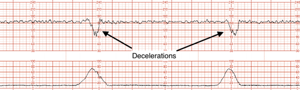 A Guide To Electronic Fetal Monitoring/Cardiotocogram - Stepwards