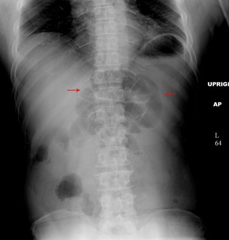 Interpreting An Abdominal X-Ray (KUB) - Stepwards