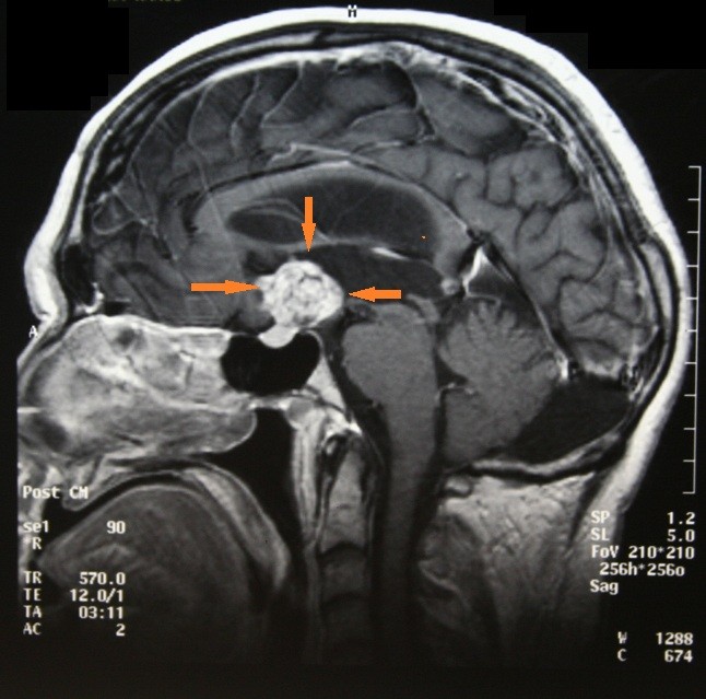 Craniopharyngioma - Stepwards