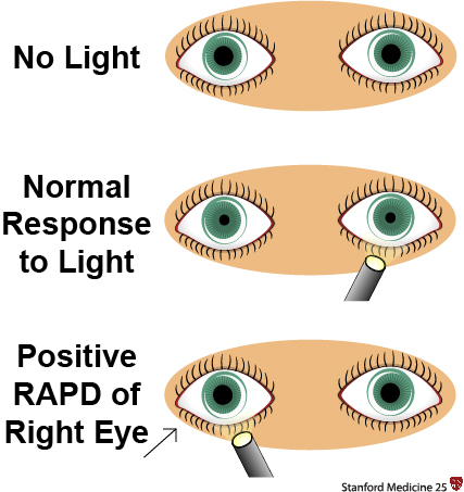 Relative Afferent Pupillary Defect - Stepwards