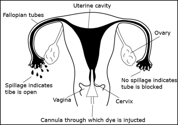 Hysterosalpingogram - Stepwards