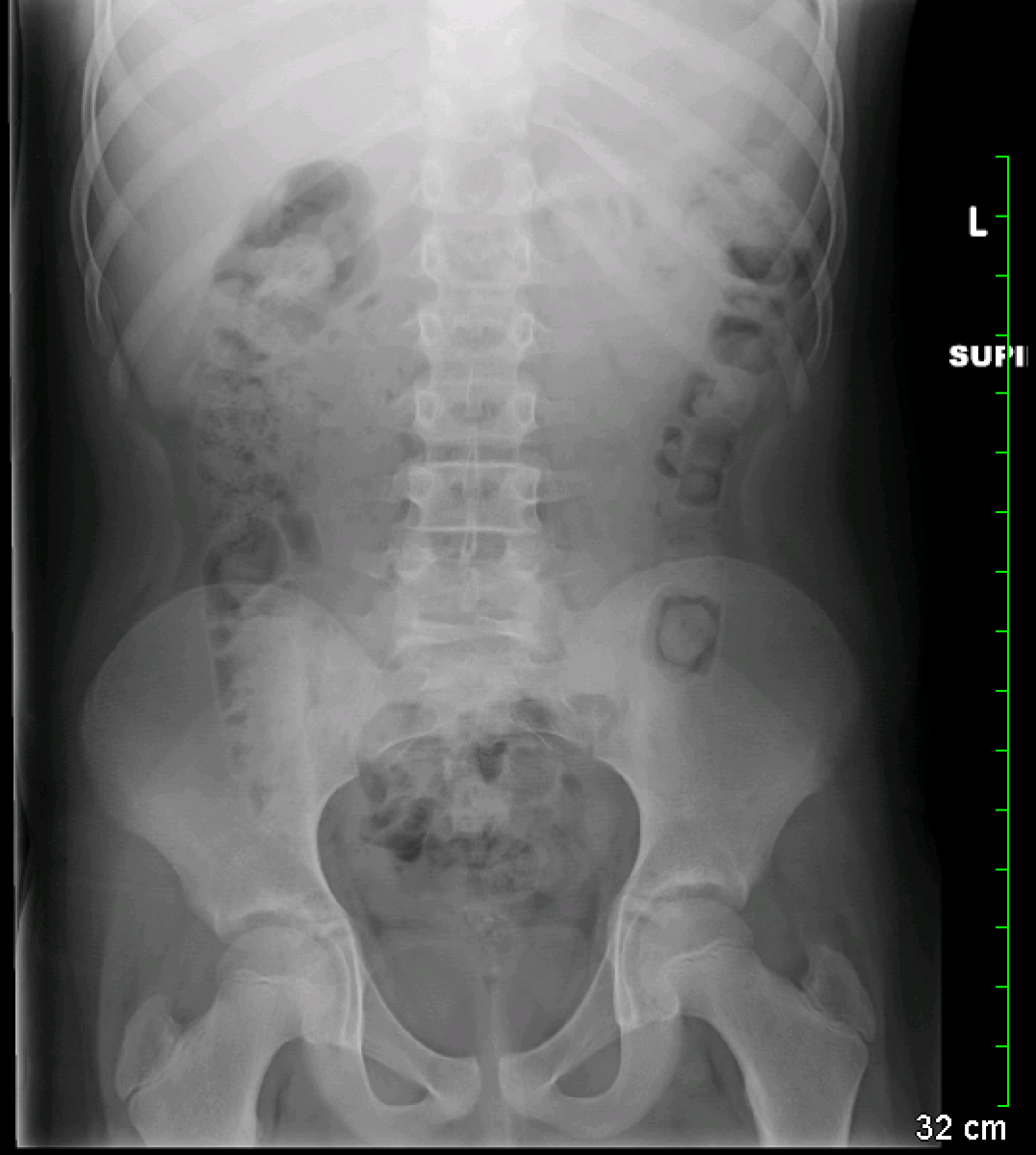 Archive Of Unremarkable Radiological Studies Abdominal X Ray KUB