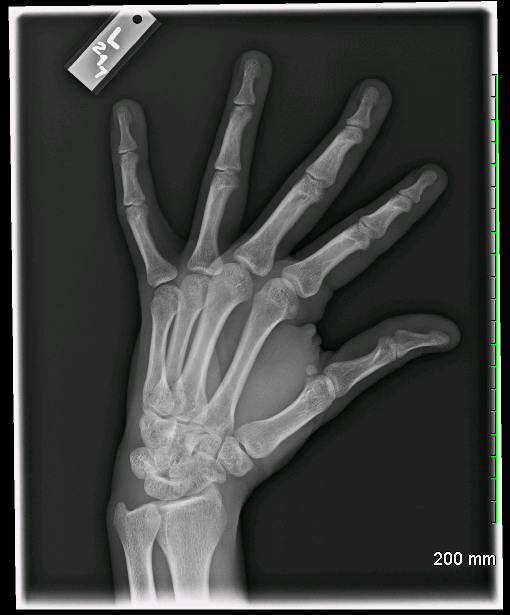Archive Of Unremarkable Radiological Studies: Left Hand X-Ray - Stepwards