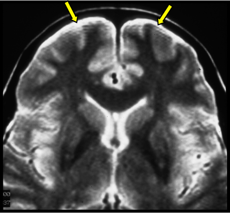 Fundamentals Of MRI Studies: MRI Artifacts - Stepwards