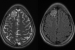 Condition Specific Radiology: Cerebral Cavernous Malformation - Stepwards