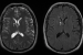 Condition Specific Radiology: Cerebral Cavernous Malformation - Stepwards