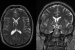 Condition Specific Radiology: Cerebral Cavernous Malformation - Stepwards