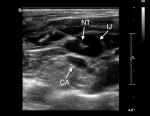 Interventional Radiology Procedures: Chest Port Placement - Stepwards