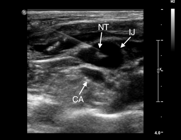 Interventional Radiology Procedures: Chest Port Placement - Stepwards