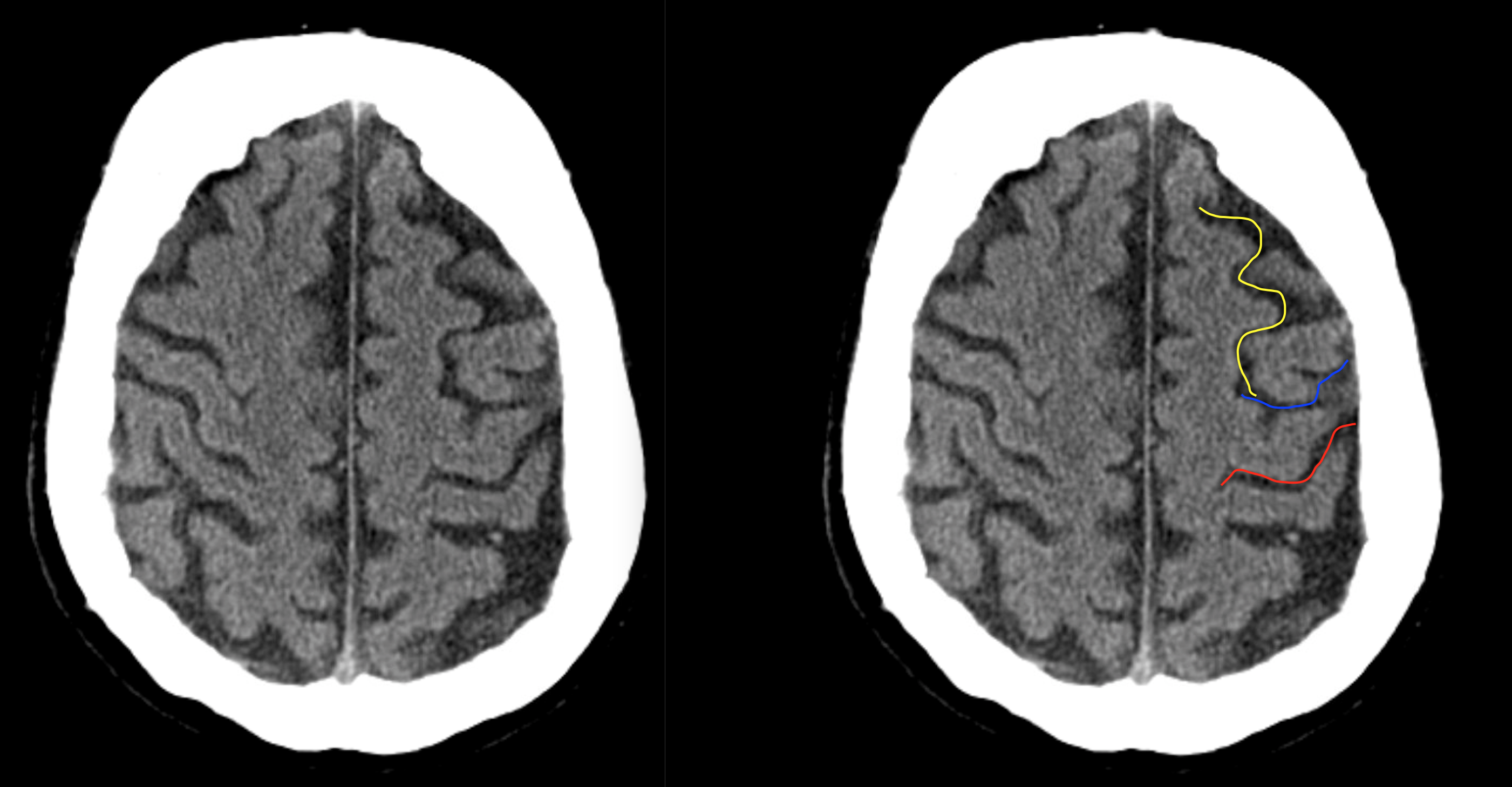 Sagittal Sulcus Of Brain
