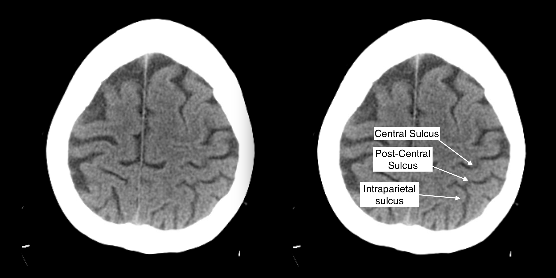 Intraparietal Sulcus