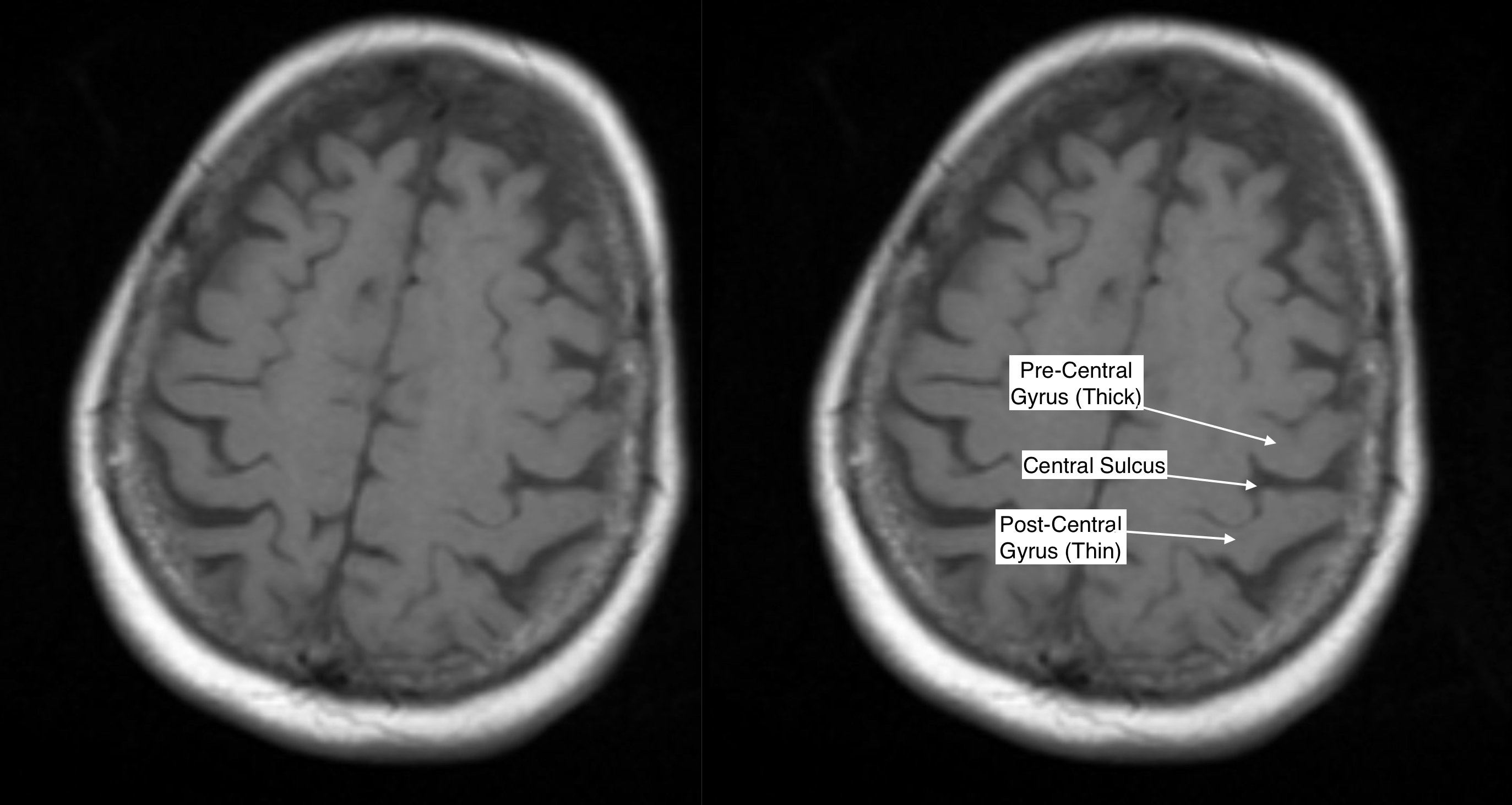 Radiological Anatomy Central Sulcus Stepwards