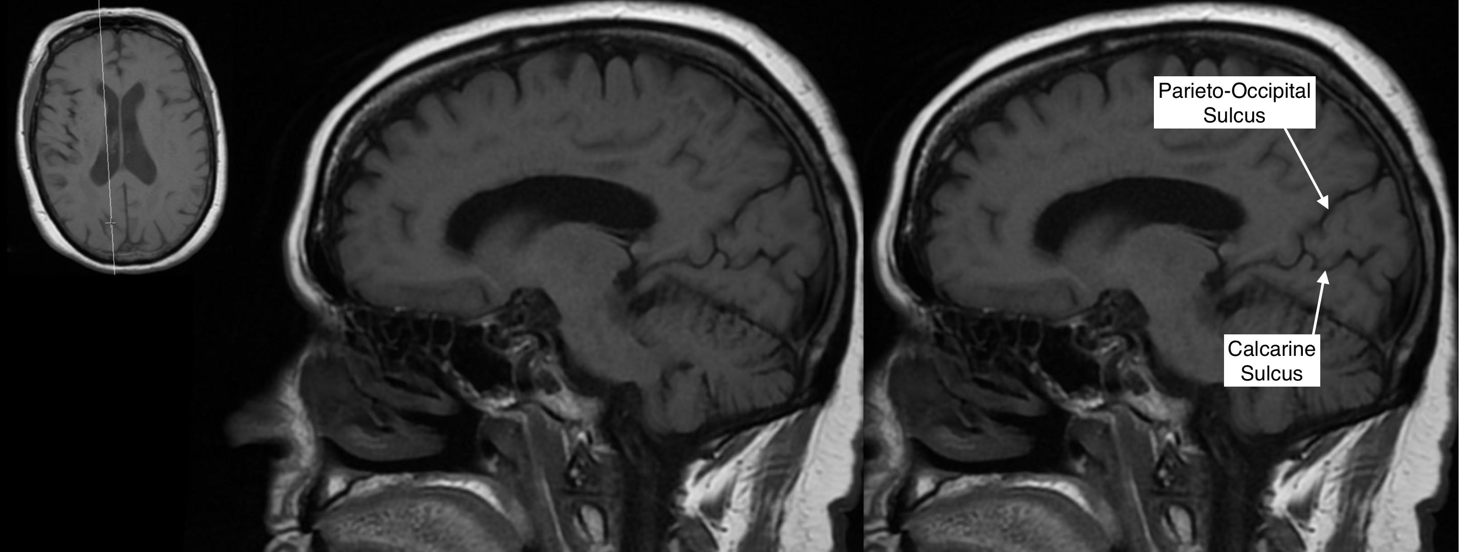Radiological Anatomy: Parieto-Occipital Sulcus - Stepwards