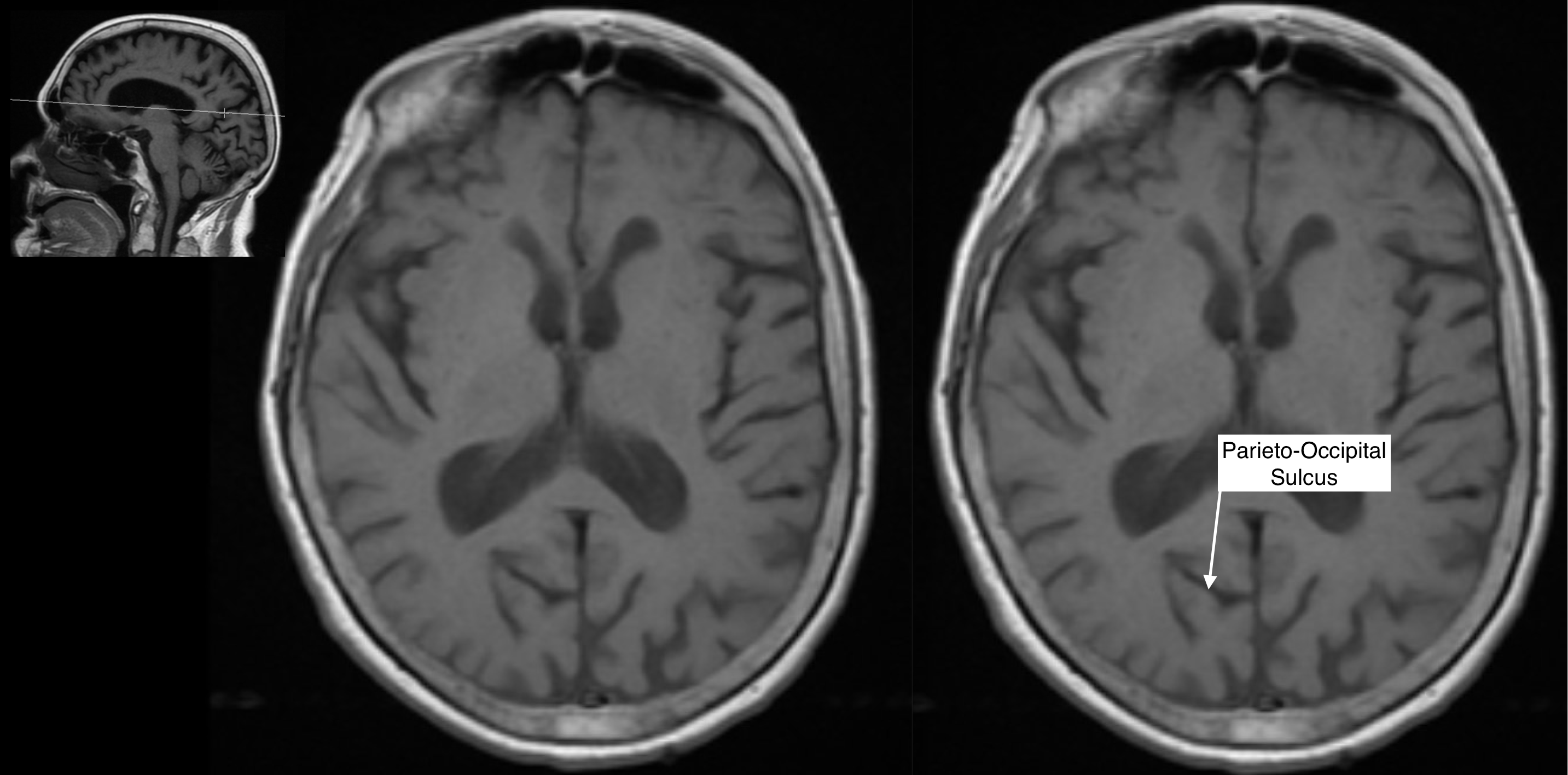 Radiological Anatomy: Parieto-Occipital Sulcus - Stepwards