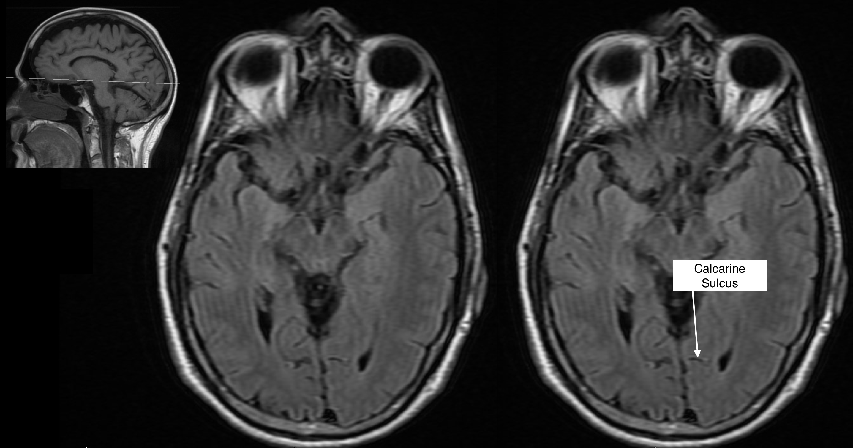 Radiological Anatomy: Calcarine Sulcus - Stepwards