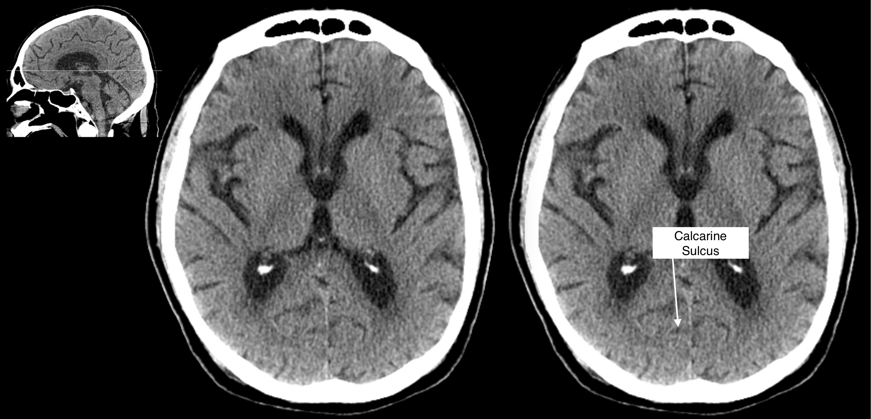 Radiological Anatomy: Calcarine Sulcus - Stepwards