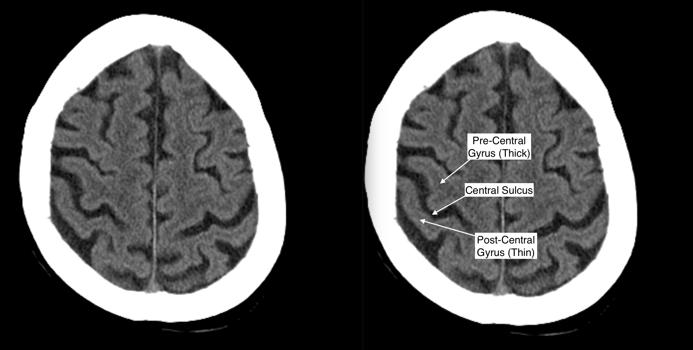 Radiological Anatomy Central Sulcus Stepwards