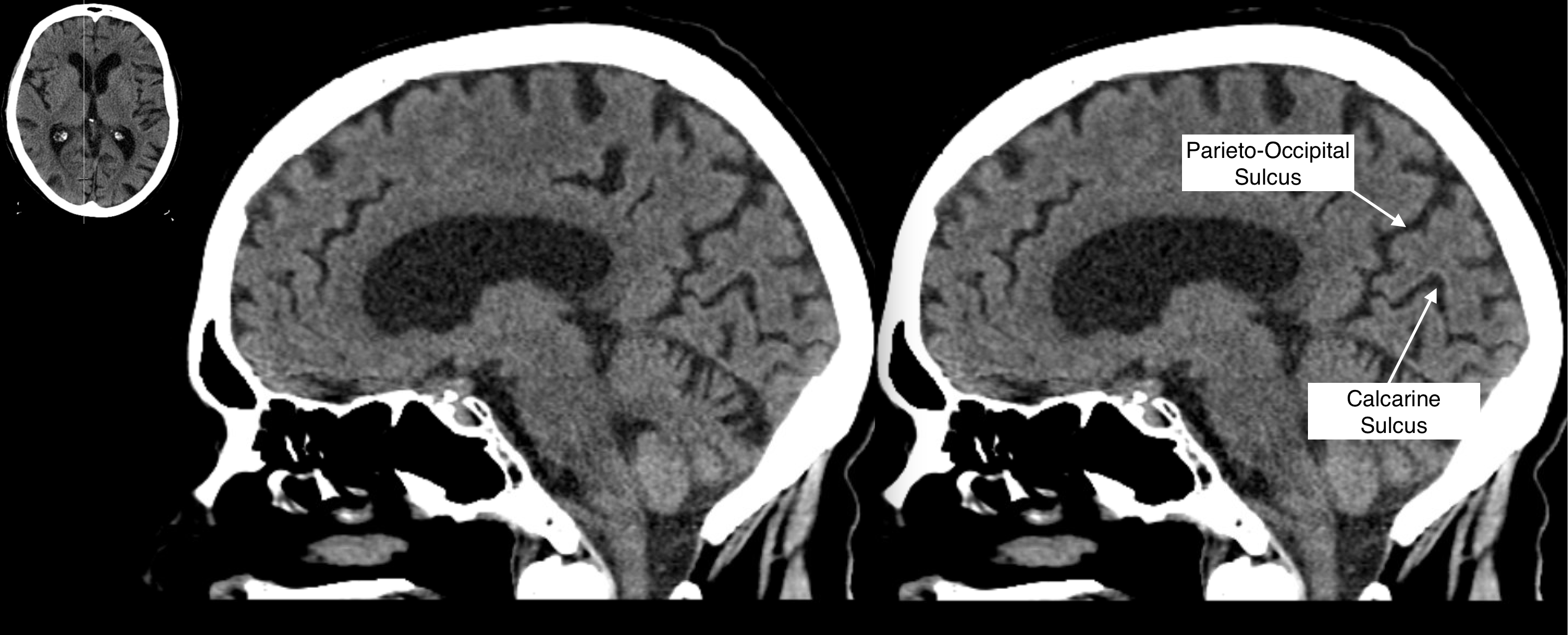 Radiological Anatomy: Calcarine Sulcus - Stepwards