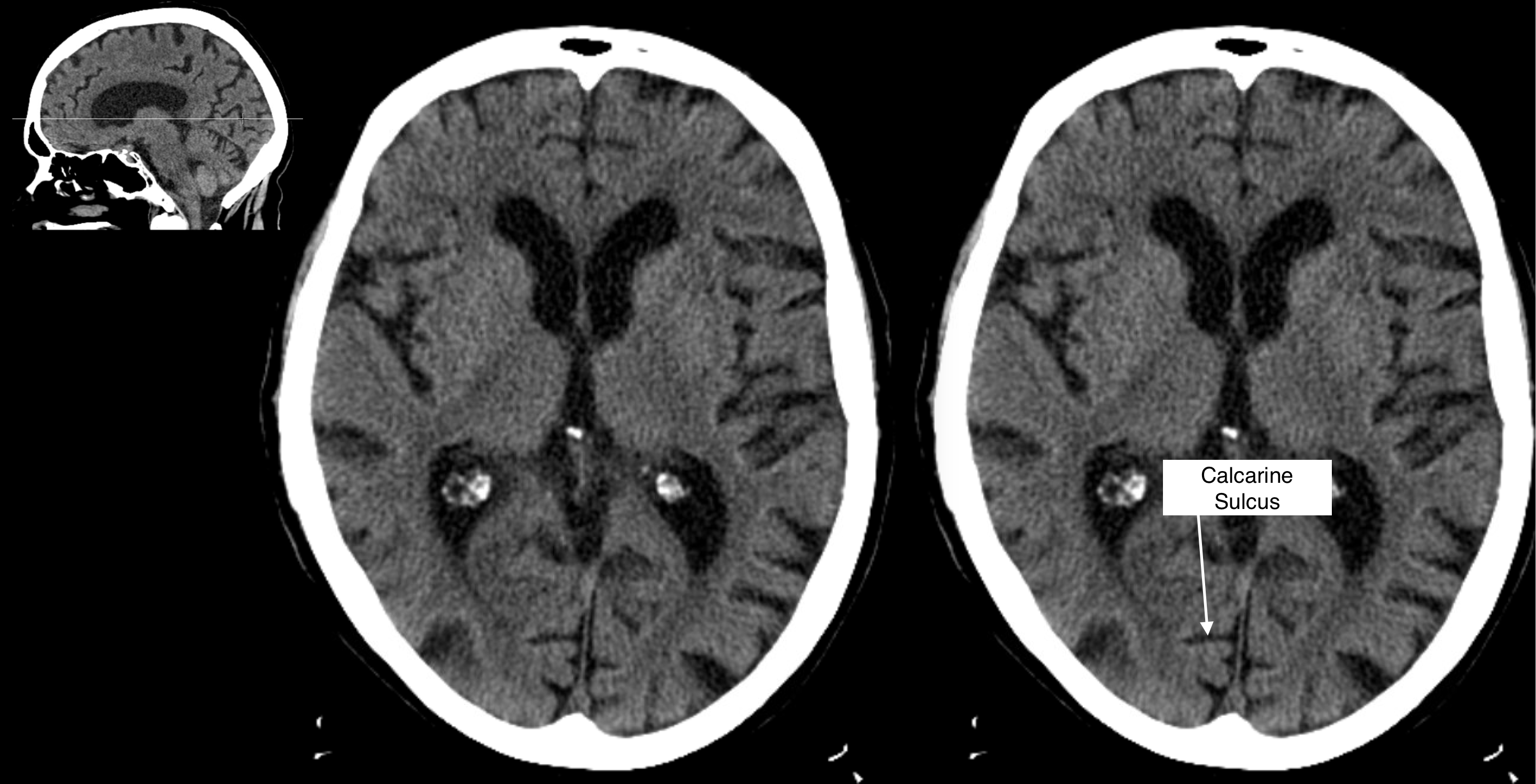 Radiological Anatomy: Calcarine Sulcus - Stepwards