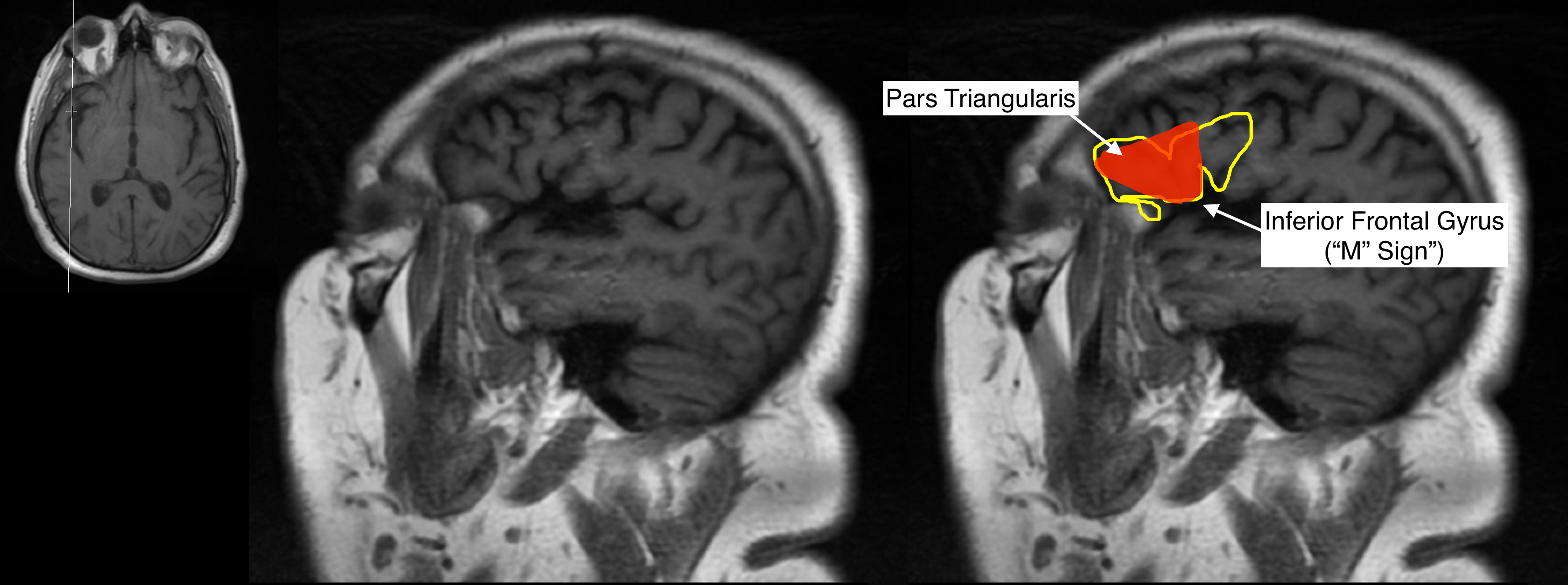 Radiological Anatomy: Pars Triangularis - Stepwards