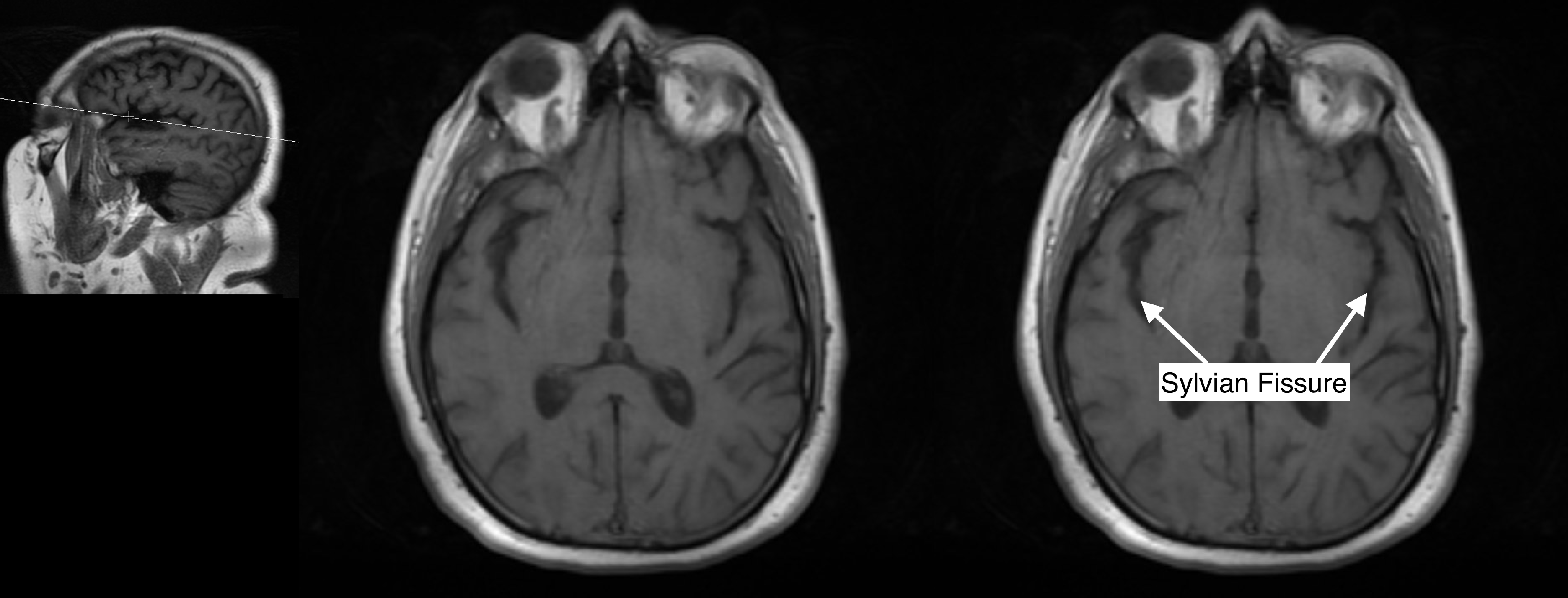Radiological Anatomy: Sylvian Fissure - Stepwards