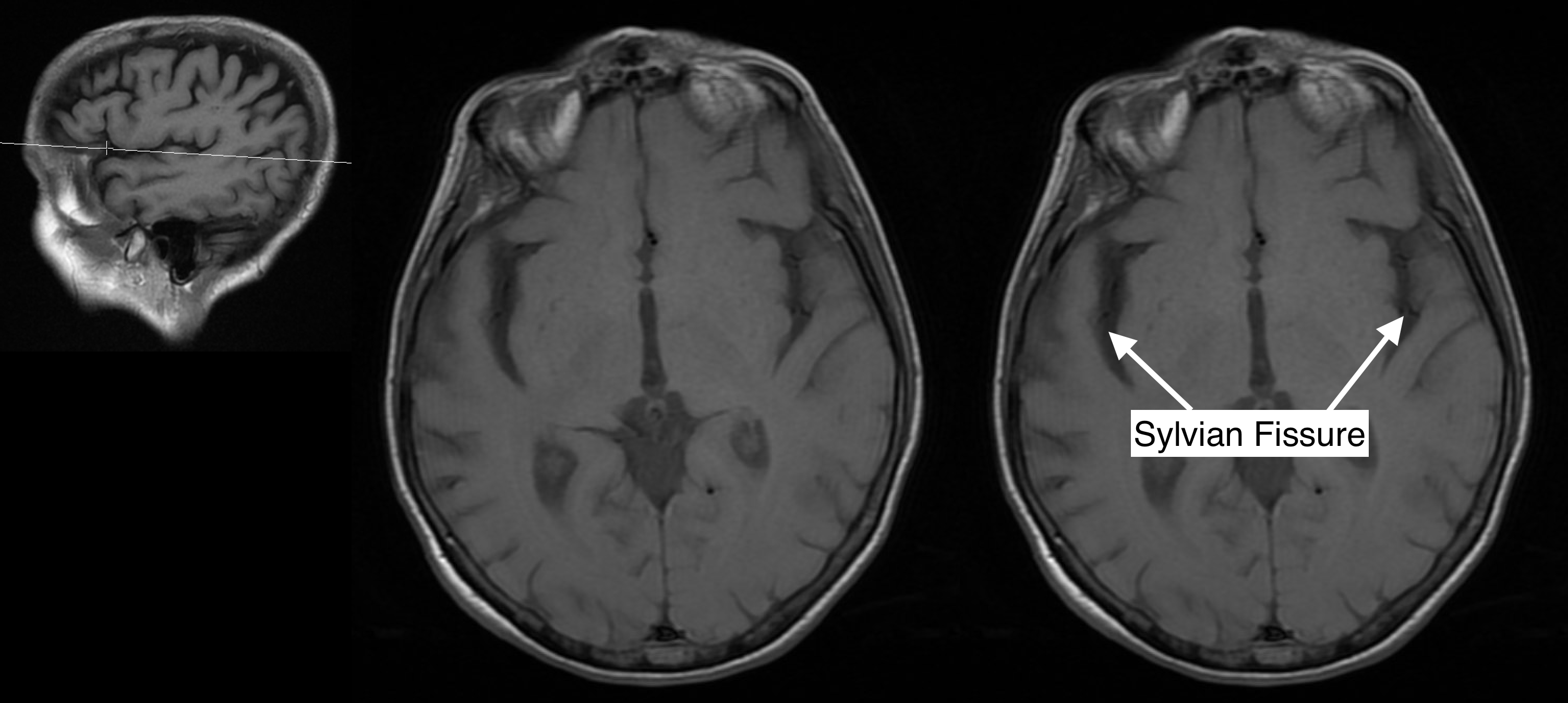 Radiological Anatomy: Sylvian Fissure - Stepwards