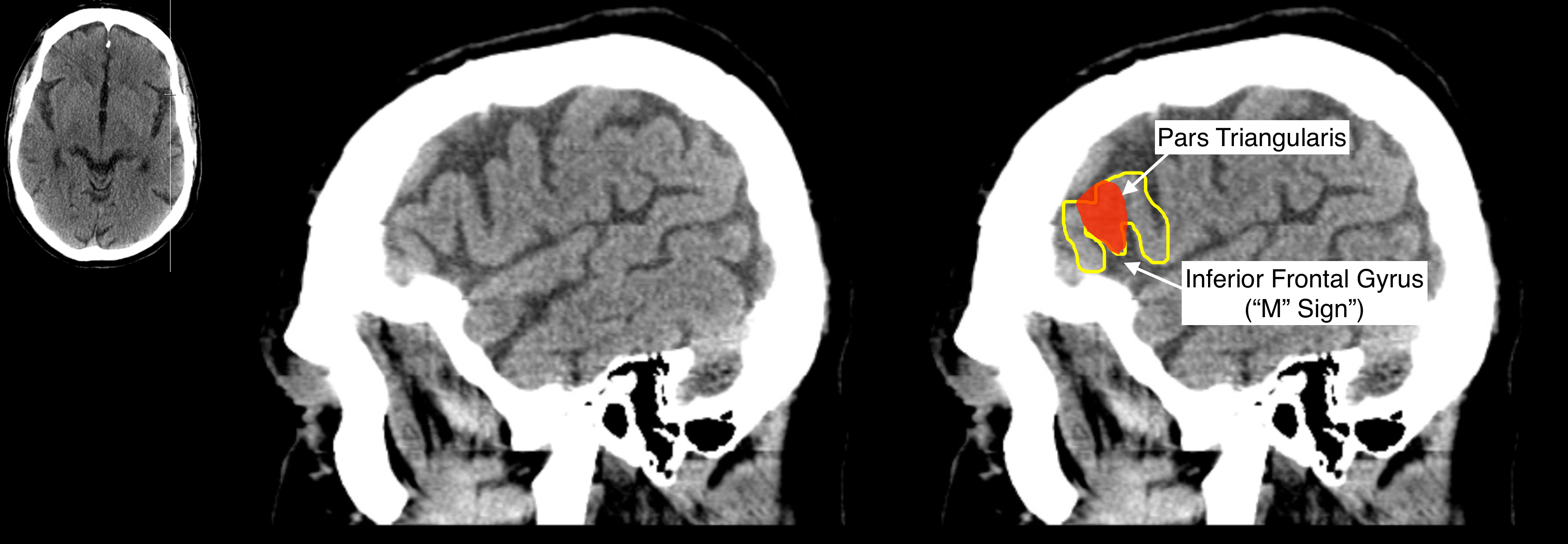 Radiological Anatomy: Pars Triangularis - Stepwards