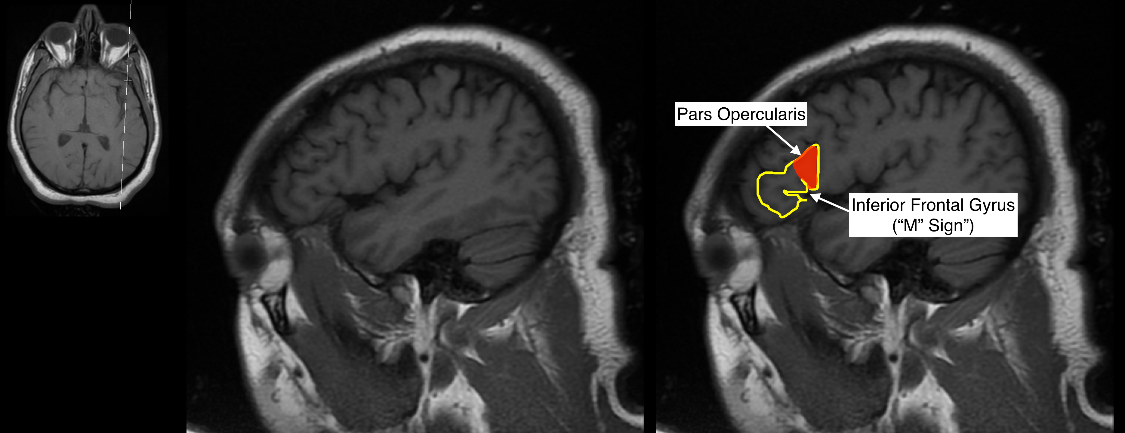 Radiological Anatomy: Pars Opercularis - Stepwards