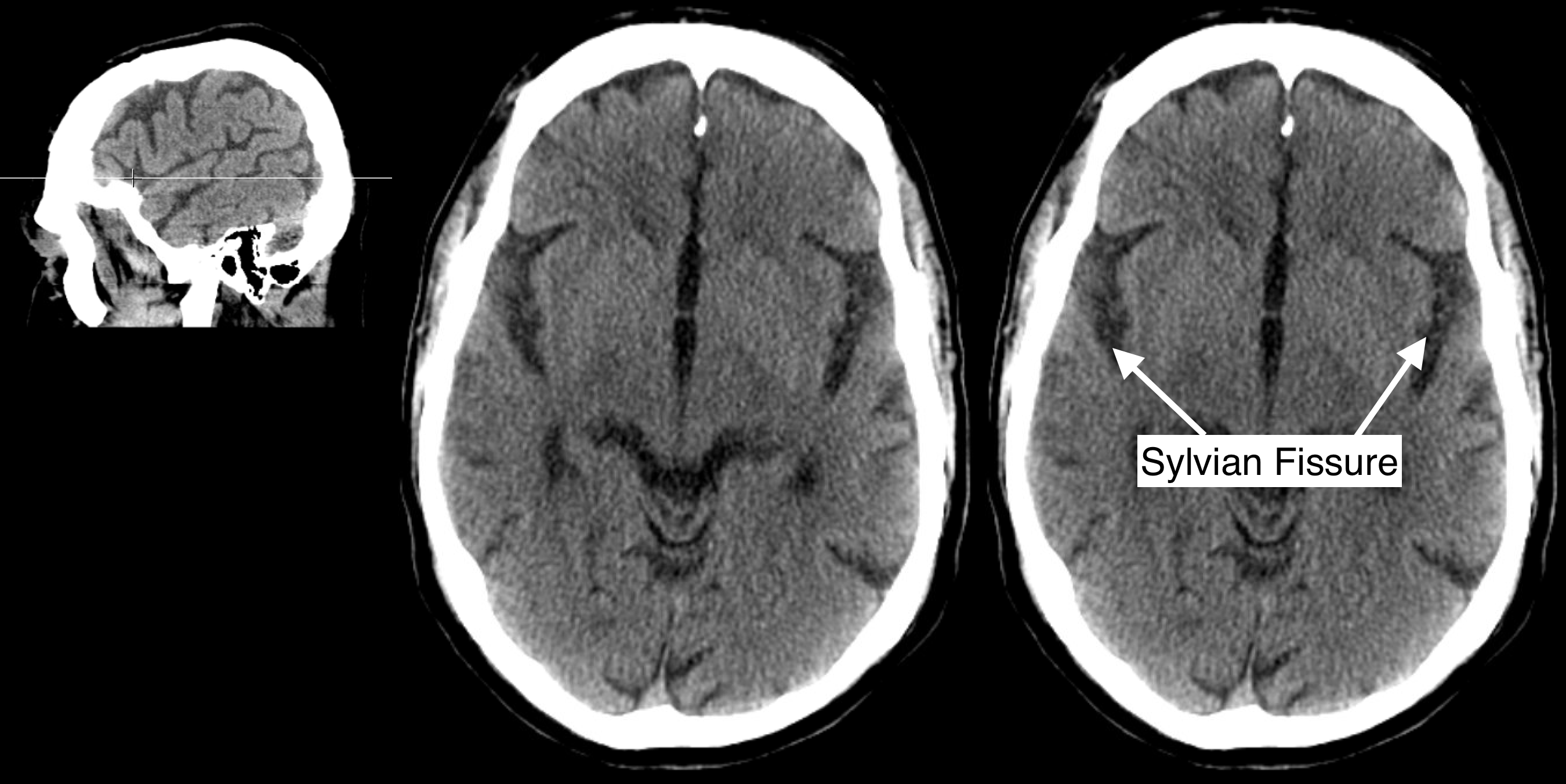Radiological Anatomy: Sylvian Fissure - Stepwards
