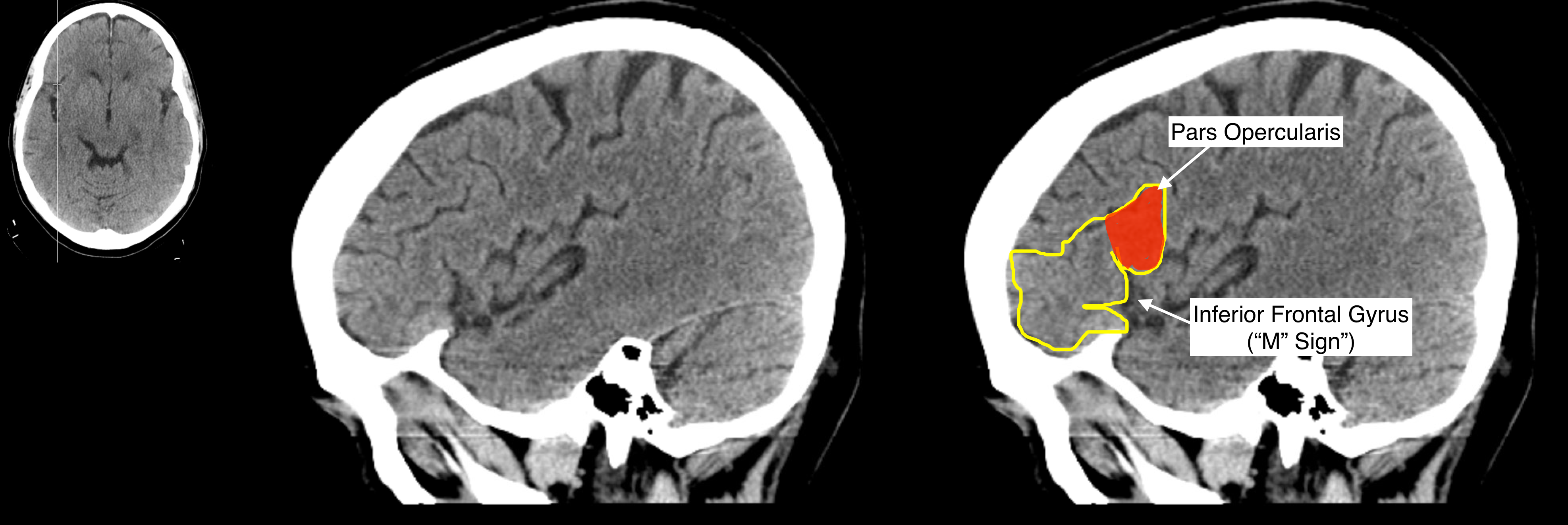 Radiological Anatomy: Pars Opercularis - Stepwards