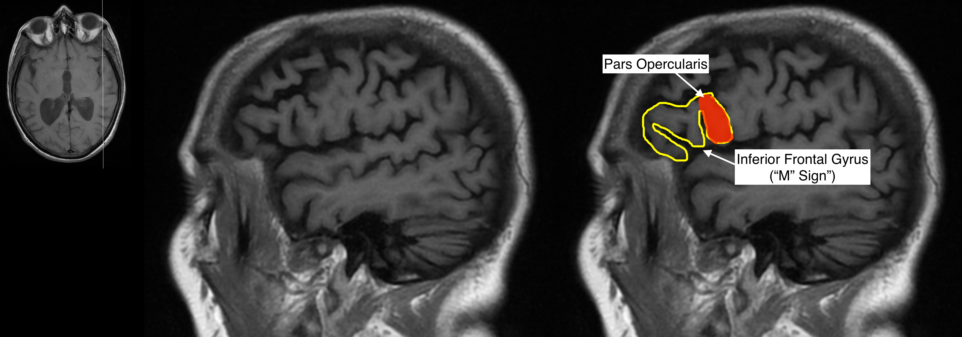 Radiological Anatomy: Pars Opercularis - Stepwards